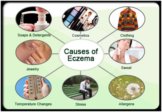 Ekcem – Dermatoloski ispitan prirodni krem